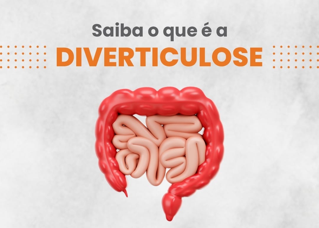 Sabiba o que é Diverticulose – NAPHE